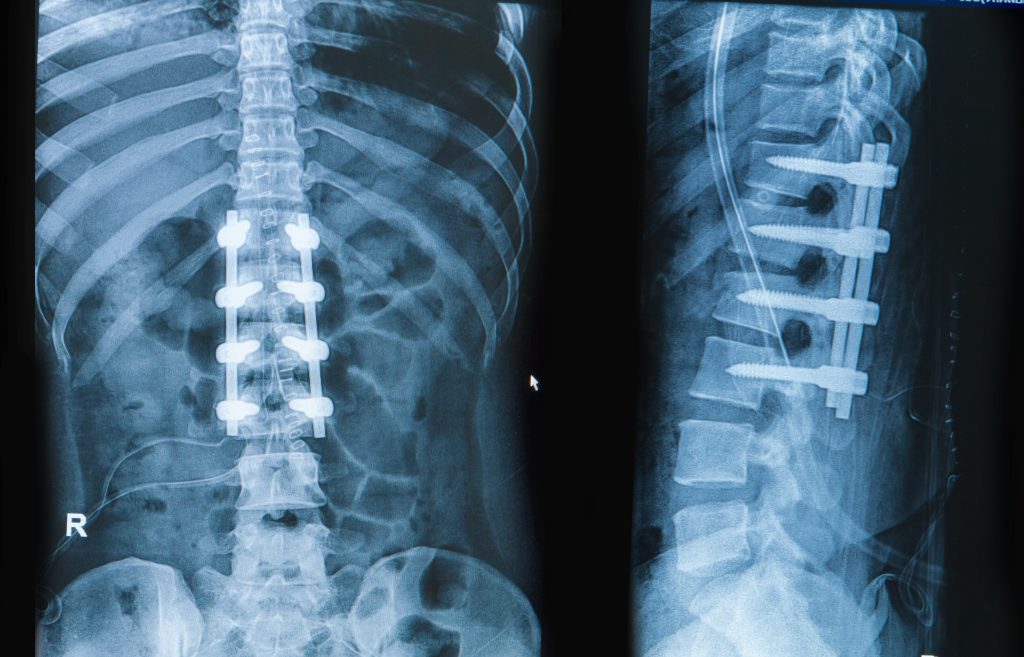 Different Types of Spinal Implants | Oasis Orthopedic & Spine